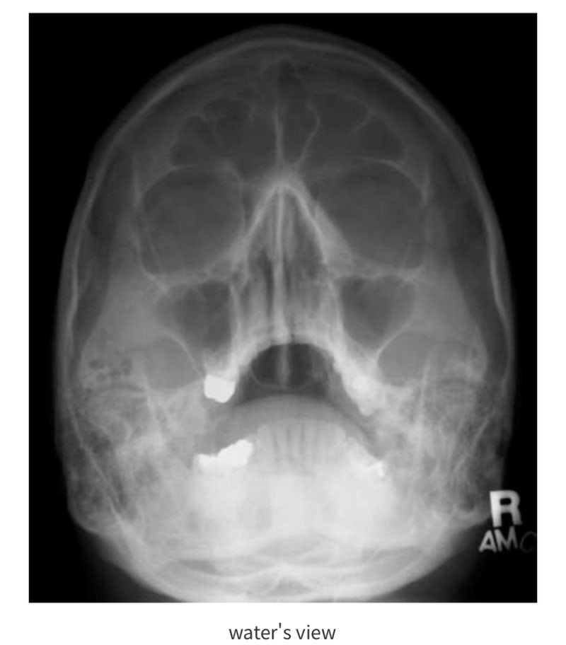일반촬영 초보의 [PNS Series] 촬영법 쉬운설명 : 네이버 블로그