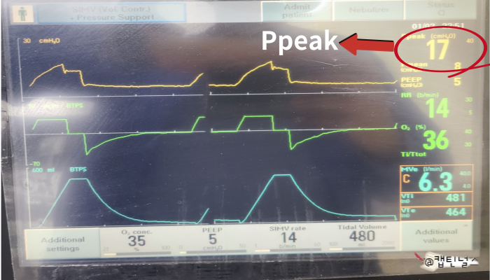 인공호흡기 Ventilator Setting 용어 의미(I:E, Tidal, Volume, PEEP, Mve, Ppeak ...