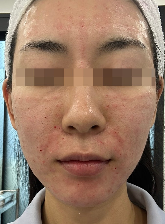 리쥬란 효과주기엠보가격 2회차 총정리 네이버 블로그