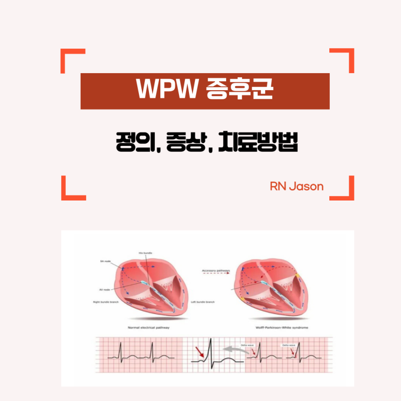 WPW 증후군(syndrome)의 쉬운 설명과 치료 방법에 대해 알아봐요! : 네이버 블로그