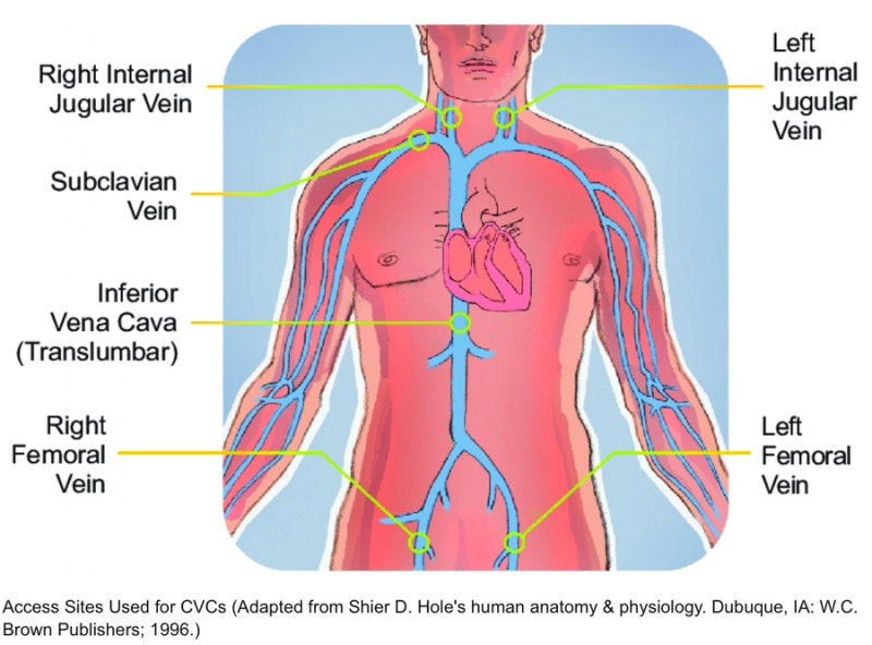 의학용어 PICC, 케모포트(Chemoport), 히크만 카테터, Vascath, Permcath 비교 공부하기 : 네이버 블로그