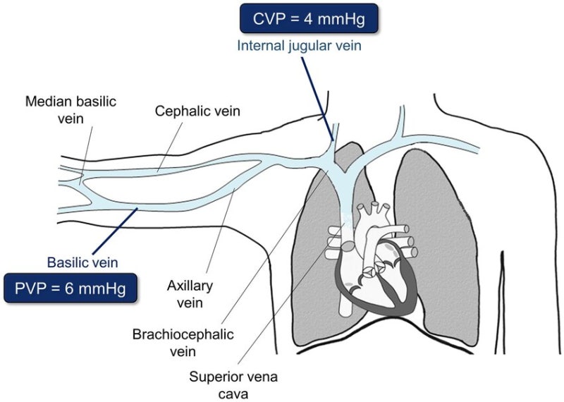 CVP(Central Venous Pressure) :: CVP 기본, 측정방법부터 CVP를 중요하게 봐야하는 상황들, CVP와 ...