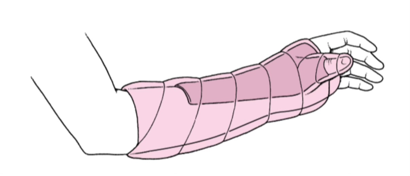 [간호사 공부] 정형외과 보조기 스플린트(Splint)의 종류에 대해 알아봅시다. : 네이버 블로그
