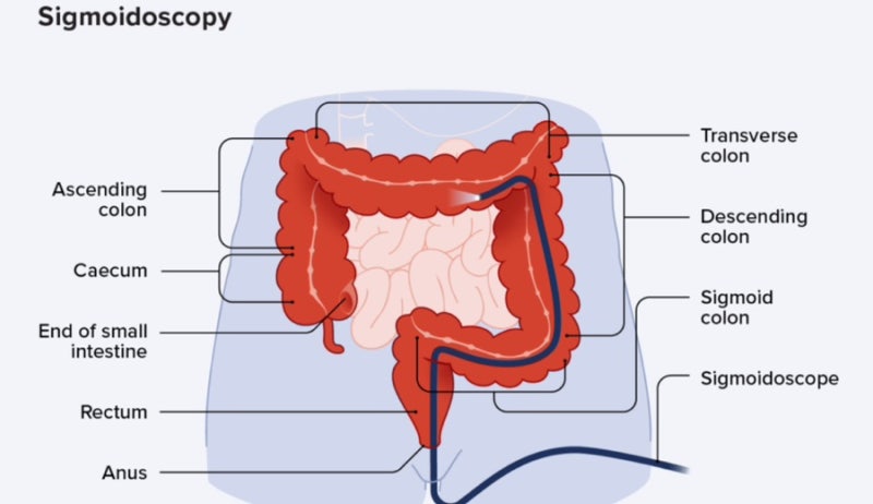 구불결장내시경검사Sigmoidoscopy란? : 네이버 블로그
