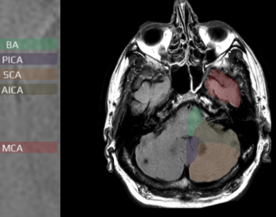 뇌경색(brain infarction) 발생부위별(MCA, ACA, PCA 등) 증상, CT&MRI 기본판독 : 네이버 블로그