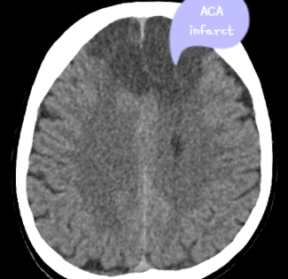 뇌경색(brain infarction) 발생부위별(MCA, ACA, PCA 등) 증상, CT&MRI 기본판독 : 네이버 블로그