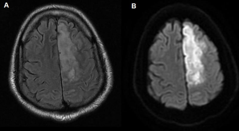 뇌경색(brain infarction) 발생부위별(MCA, ACA, PCA 등) 증상, CT&MRI 기본판독 : 네이버 블로그