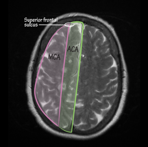 뇌경색(brain infarction) 발생부위별(MCA, ACA, PCA 등) 증상, CT&MRI 기본판독 : 네이버 블로그
