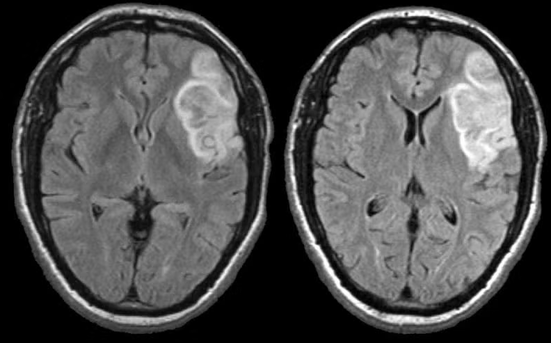 뇌경색(brain infarction) 발생부위별(MCA, ACA, PCA 등) 증상, CT&MRI 기본판독 : 네이버 블로그