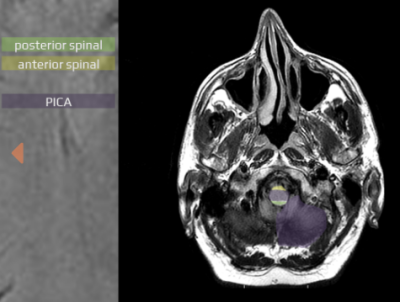 뇌경색(brain infarction) 발생부위별(MCA, ACA, PCA 등) 증상, CT&MRI 기본판독 : 네이버 블로그