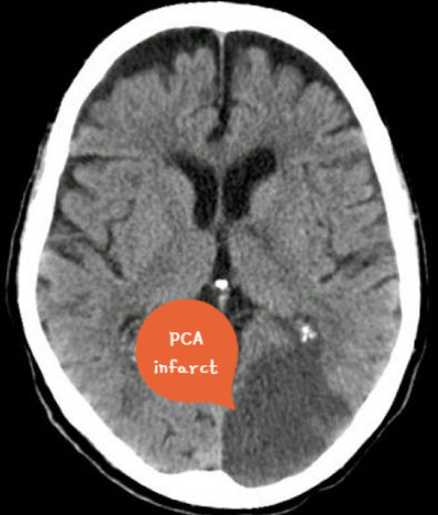 뇌경색(brain infarction) 발생부위별(MCA, ACA, PCA 등) 증상, CT&MRI 기본판독 : 네이버 블로그
