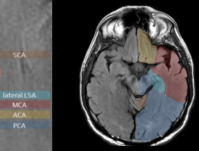 뇌경색(brain infarction) 발생부위별(MCA, ACA, PCA 등) 증상, CT&MRI 기본판독 : 네이버 블로그