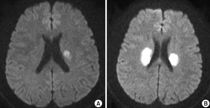 뇌경색(brain infarction) 발생부위별(MCA, ACA, PCA 등) 증상, CT&MRI 기본판독 : 네이버 블로그