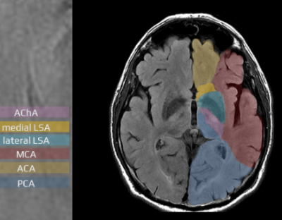 뇌경색(brain infarction) 발생부위별(MCA, ACA, PCA 등) 증상, CT&MRI 기본판독 : 네이버 블로그