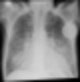 엑스레이의 모든 것 : chest x-ray CXR 엑스레이 보는 방법, Consolidation, GGO, Pleural ...