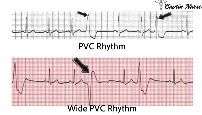의학용어 PVC 조기심실수축 원인과 증상 및 PVC Bigeminy, Trigeminy 차이는? : 네이버 블로그