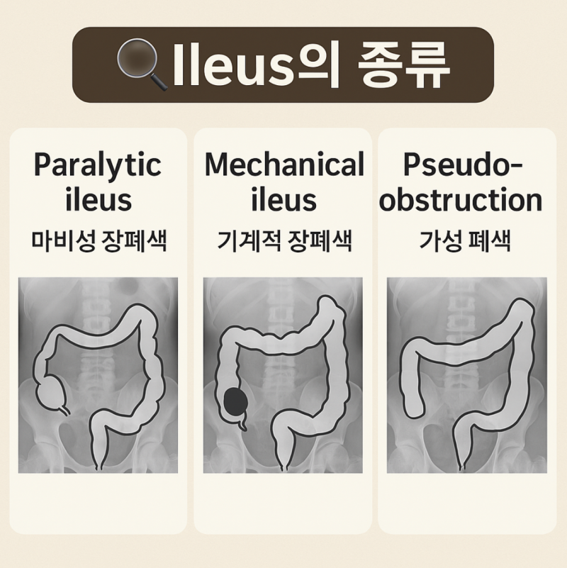 Intestinal obstruction(장폐색)이란? ileus의학용어, 원인, 증상, 수술, ileus x-ray, CT ...