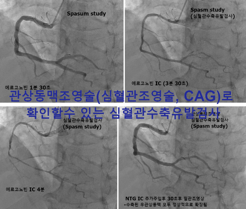 CAG 관상동맥조영술과 심혈관수축유발검사 에르고노빈테스트 Povocation test : 네이버 블로그
