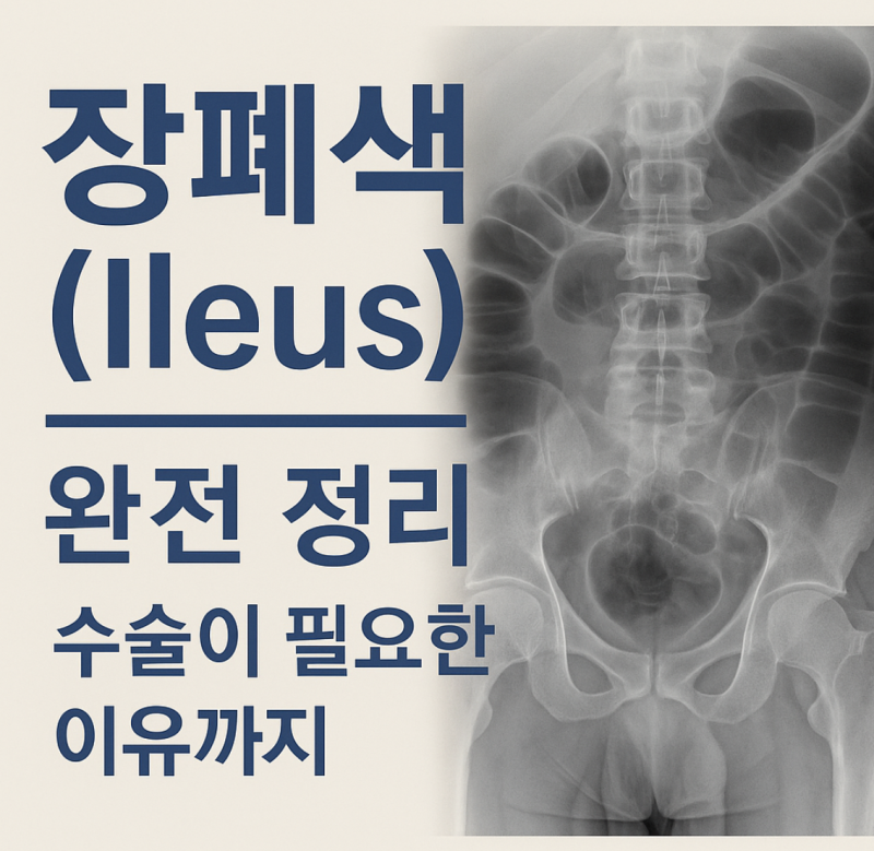 Intestinal obstruction(장폐색)이란? ileus의학용어, 원인, 증상, 수술, ileus x-ray, CT ...
