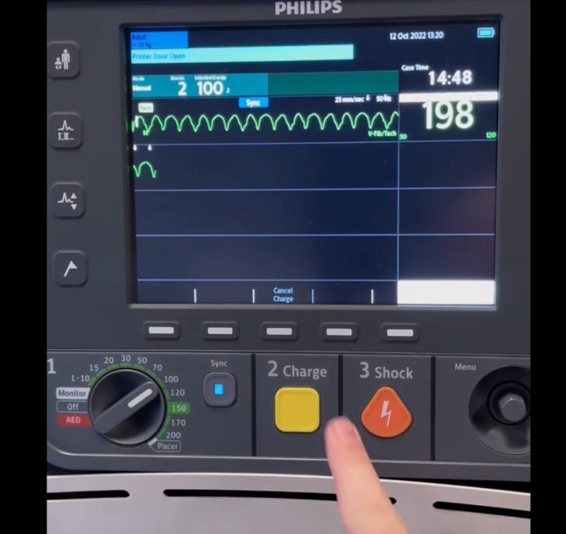 심방세동, 심방조동 의학용어 AF (Atrial fibrillation, Atrial flutter) 치료 ...