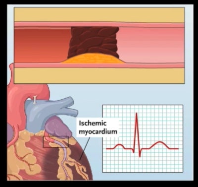 PTA 의학용어 PCI, PTCA 차이 공부하기 (feat. Angiogram 혈관조영술) : 네이버 블로그