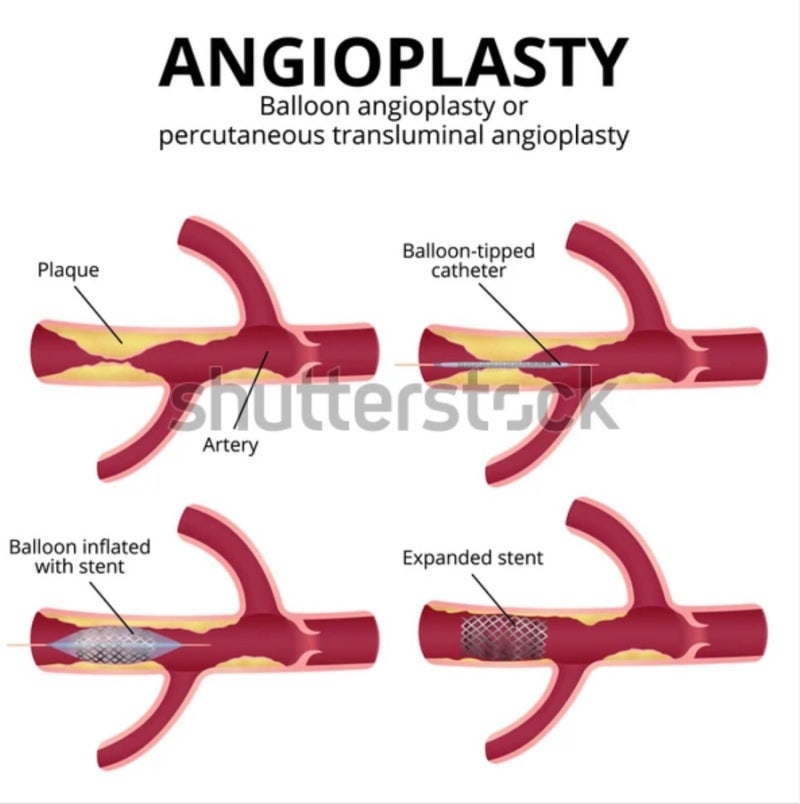 PTA 의학용어 PCI, PTCA 차이 공부하기 (feat. Angiogram 혈관조영술) : 네이버 블로그