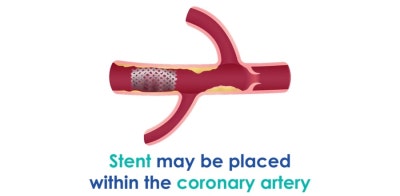 PTA 의학용어 PCI, PTCA 차이 공부하기 (feat. Angiogram 혈관조영술) : 네이버 블로그