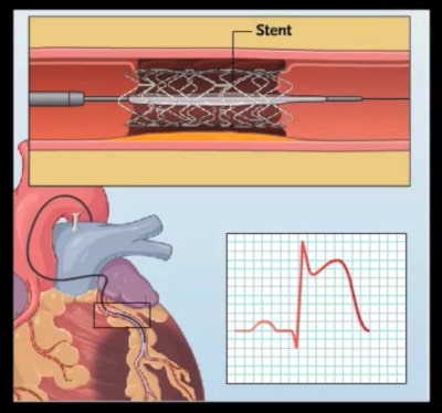 PTA 의학용어 PCI, PTCA 차이 공부하기 (feat. Angiogram 혈관조영술) : 네이버 블로그