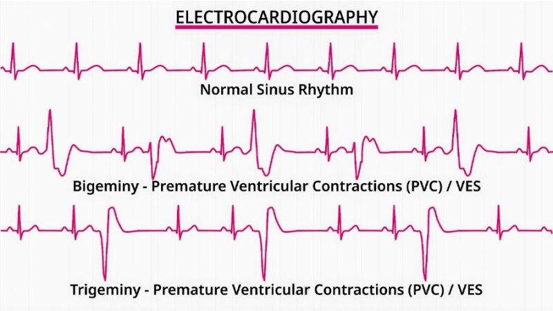 139) 심전도: VPC(Ventricular Premature Complex, PVC) 조기 심실 수축 + Bigeminy ...