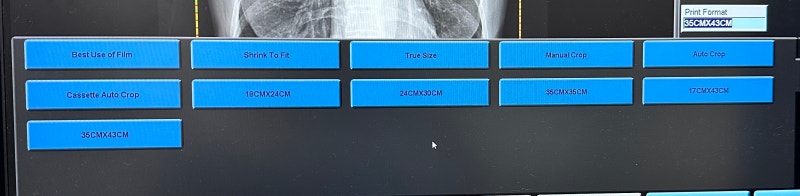 Knee AP,PA,ROSENBERG(Both Lat, Merchant)촬영법 무릎관절 X-RAY검사법 소개 : 네이버 블로그