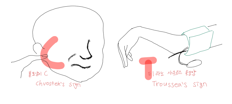 [키미캐니8강③] 저칼륨혈증, 고칼륨혈증, 저칼슘혈증, 나트륨 : 증상(Chvostek’s sign,Troussea’s sign ...