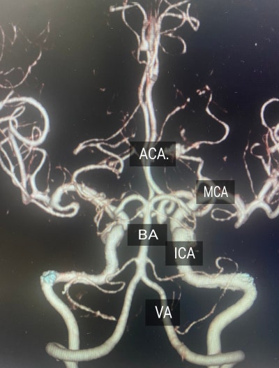뇌혈관 해부학(Neurovascular Anatomy),뇌혈관구조와 Segment 쉽게 이해하기 : 네이버 블로그