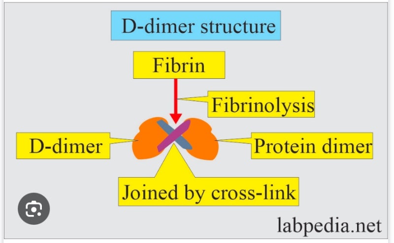 D-dimer 디다이머 검사, 의학용어 DVT, Fibrinogen 피브리노겐 상관관계 공부하기 : 네이버 블로그