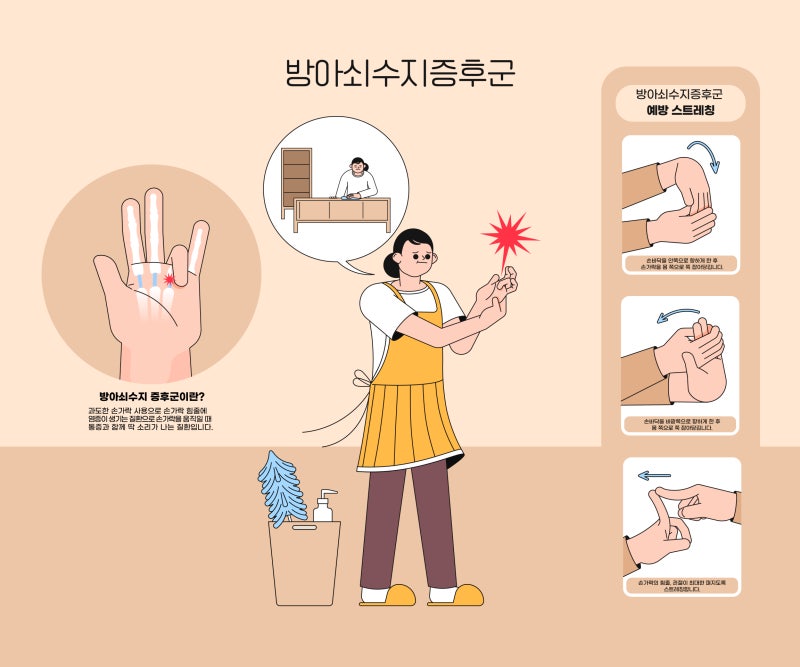 인천 방아쇠수지 방아쇠수지증후군 증상 원인 치료법 완벽 정리 뉴성민병원 네이버 블로그