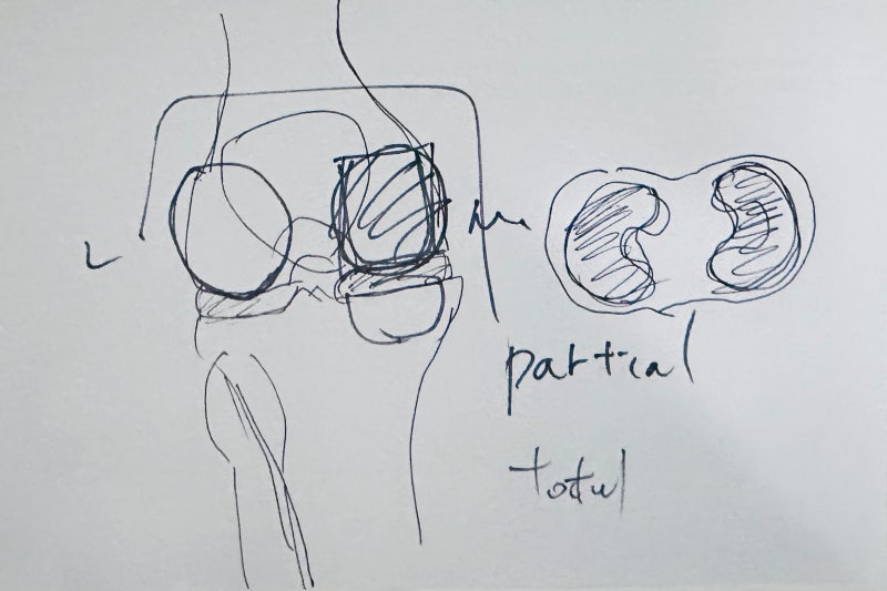 Knee AP,PA,ROSENBERG(Both Lat, Merchant)촬영법 무릎관절 X-RAY검사법 소개 : 네이버 블로그