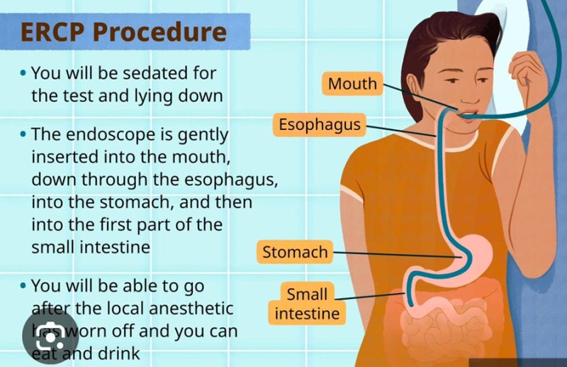 ERCP 의학용어 PTBD, MRCP 차이 공부하기 : 네이버 블로그