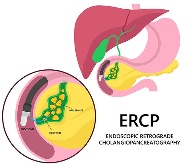 ERCP 의학용어 PTBD, MRCP 차이 공부하기 : 네이버 블로그