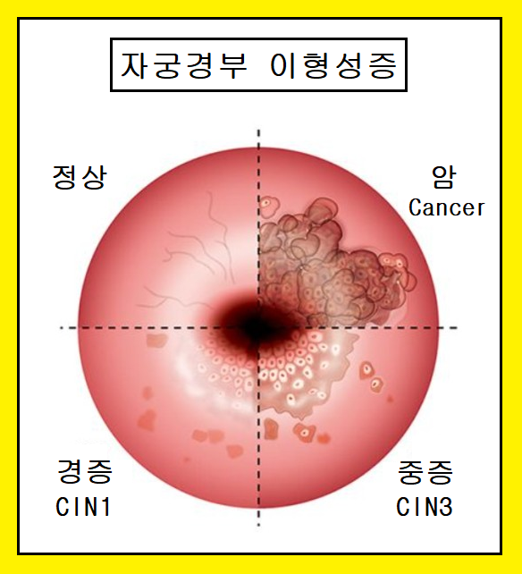 자궁경부 이형성증 제자리암상피내암 진단금 완벽하게 알아보기 네이버 블로그