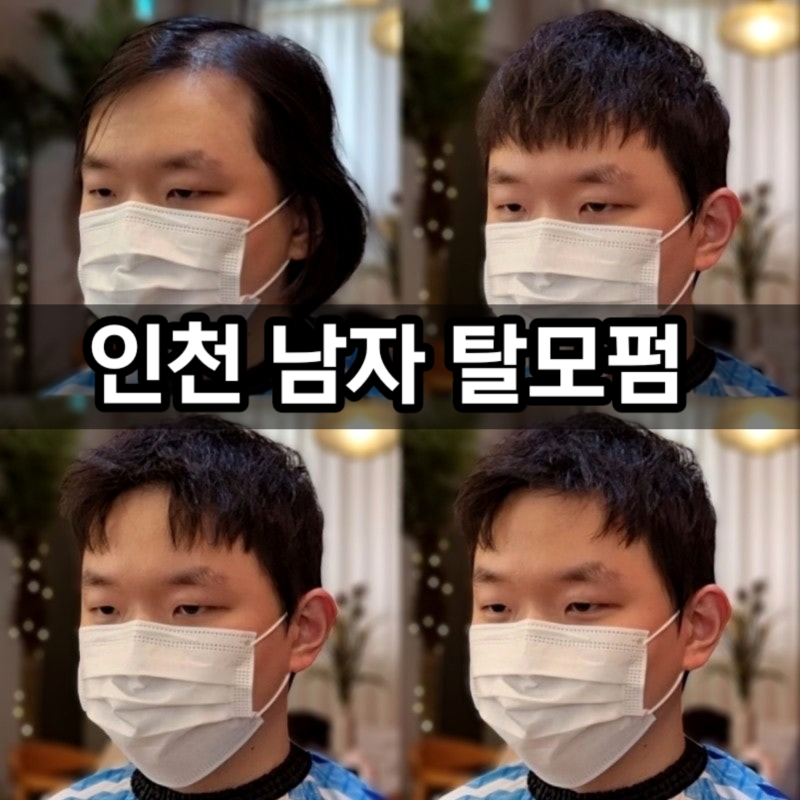 인천 탈모펌 후기 모발이식 탈모병원 클리닉 받기전에 남자 탈모 펌 하세요 간석동 남자 파마 남자 탈모 커버 펌 전문 1인
