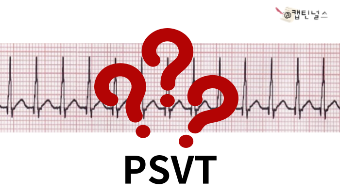 PSVT 발작성 상심실성 빈맥 원인 및 EKG 특징과 증상 그리고 치료방법 : 네이버 블로그