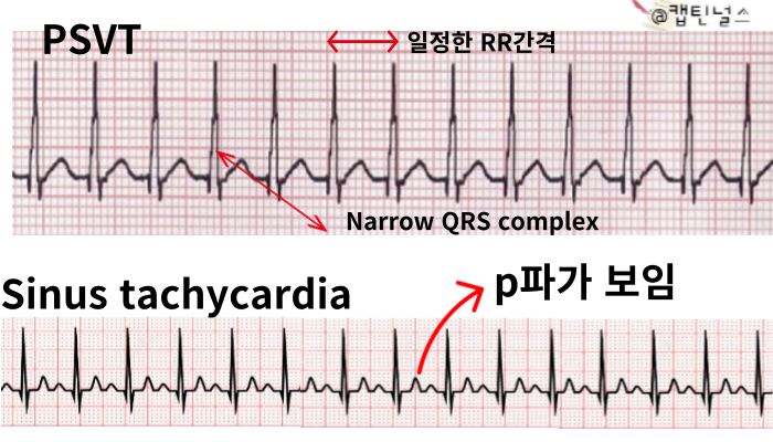 PSVT 발작성 상심실성 빈맥 원인 및 EKG 특징과 증상 그리고 치료방법 : 네이버 블로그