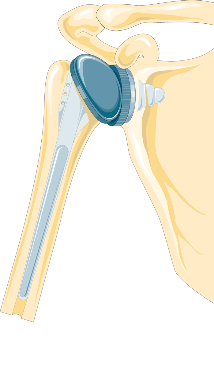 어깨 인공관절 수술 완벽 가이드: TSA와 RSA 차이점, 수술 절차, 자세까지 총정리 : 네이버 블로그
