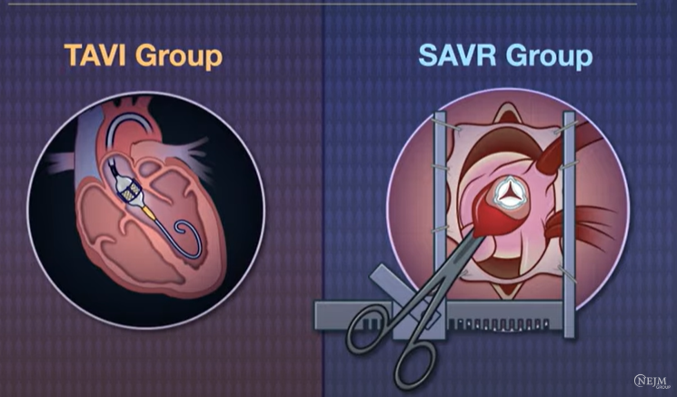 경피적대동맥판막 치환술, TAVI 시술(적응증, 수술과 비교, 과정, 간호, 부작용 급여 비용) : 네이버 블로그