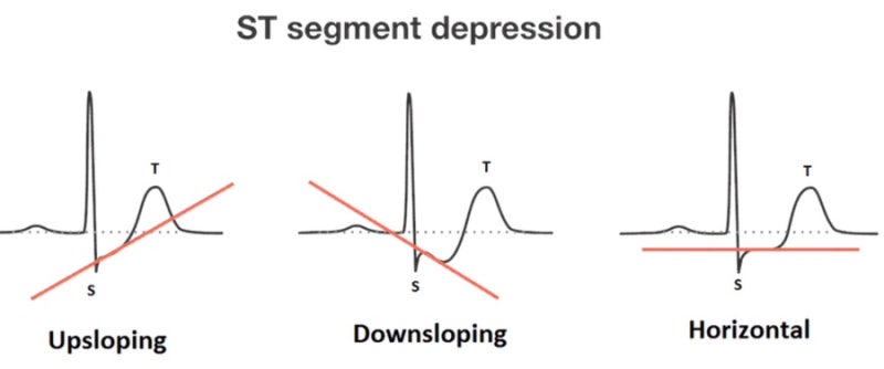 ST elevation, ST depression, T wave inversion 의미 공부하기 : 네이버 블로그