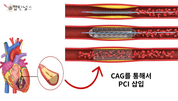 CAG(Coronary Angiography) 시행하는 이유와 RCA, LCA, LCX, LAD 위치는? : 네이버 블로그