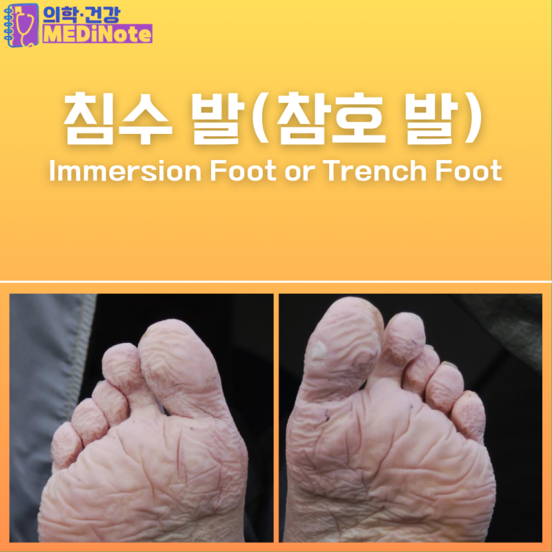 침수 발(Immersion Foot) 혹은 참호 발(Trench Foot): 원인, 증상, 치료 및 예방 방법ㅣ메디노트 ...