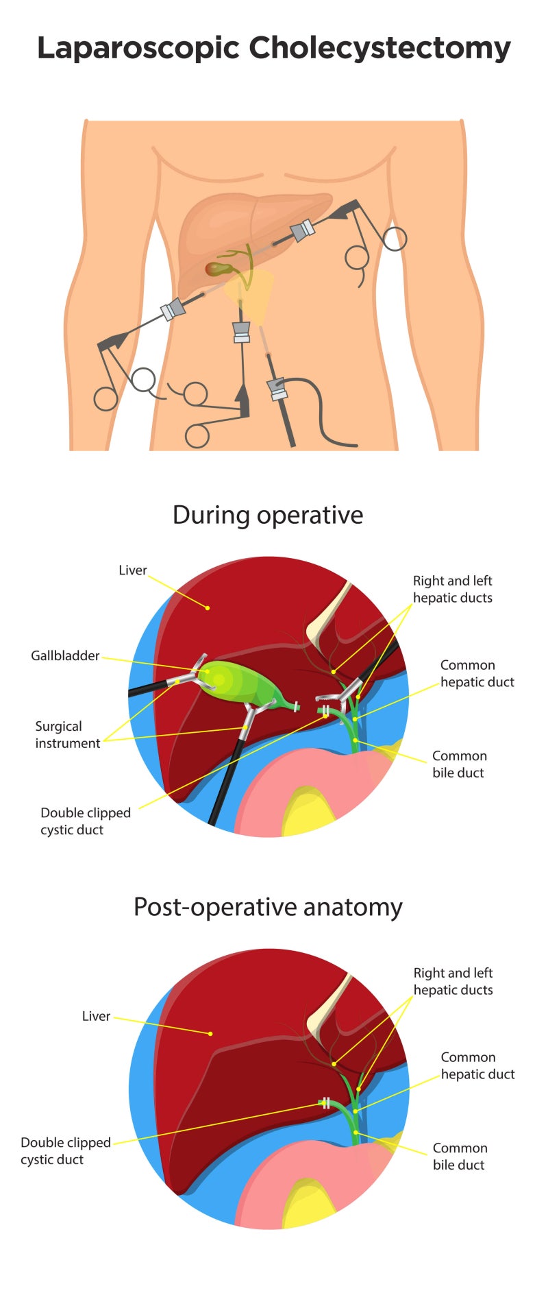 담낭절제술 (Cholecystectomy)요약 : 네이버 블로그