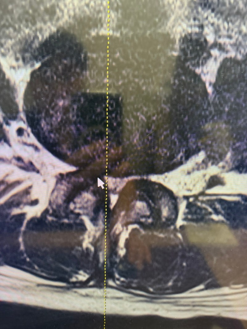 광주 남구 허리디스크 | 신경외과 의사도 수술 권유, 운동으로 회복 중입니다. : 네이버 블로그