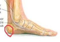 세버병(Sever's apophysitis) - 뒤꿈치통증 : 네이버 블로그