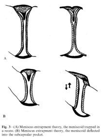 Theoretical proposals of acute locked back : 네이버 블로그